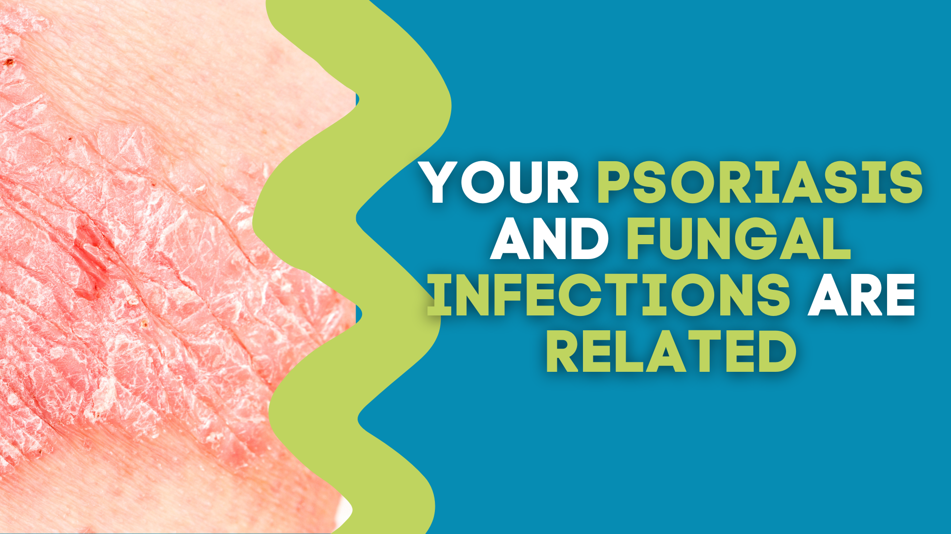 YOUR PSORIASIS AND FUNGAL INFECTIONS ARE RELATED – The Gut Health Hub